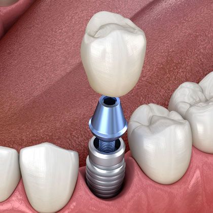 Dental Solutions: Dentist Warsaw, IN