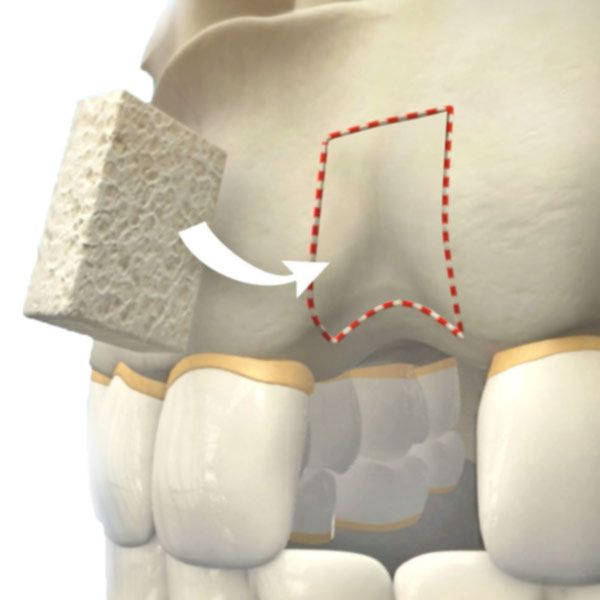 Bone Grafting – Staten Island, NY – Dr. Alex Hecht