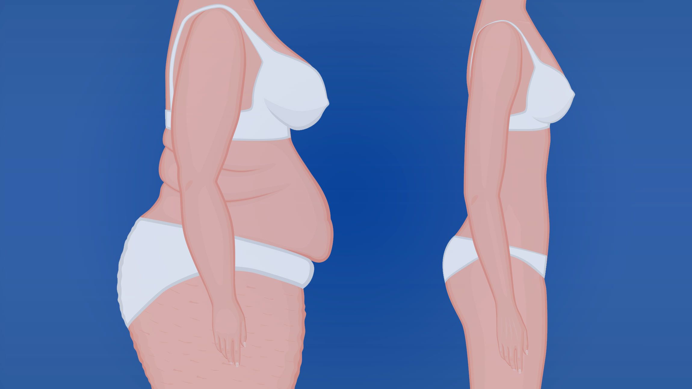 After 30 Years New Guidelines For Weight Loss Surgery Global Health After 30 Years New Guidelines For Weight Loss Surgery Global Health