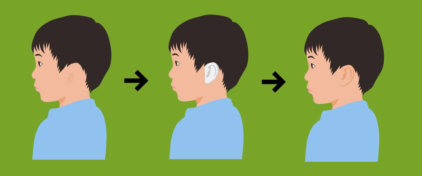 Microtia Treatment from an Expert Surgeon in Beverly Hills