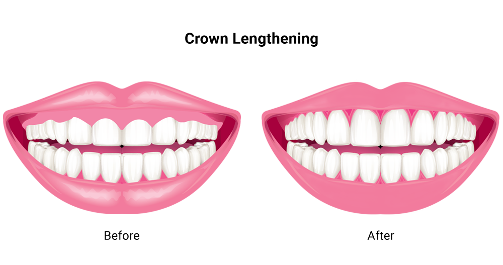 Crown Lengthening - Lakewood, CO - Dr. Brian J. Polidori