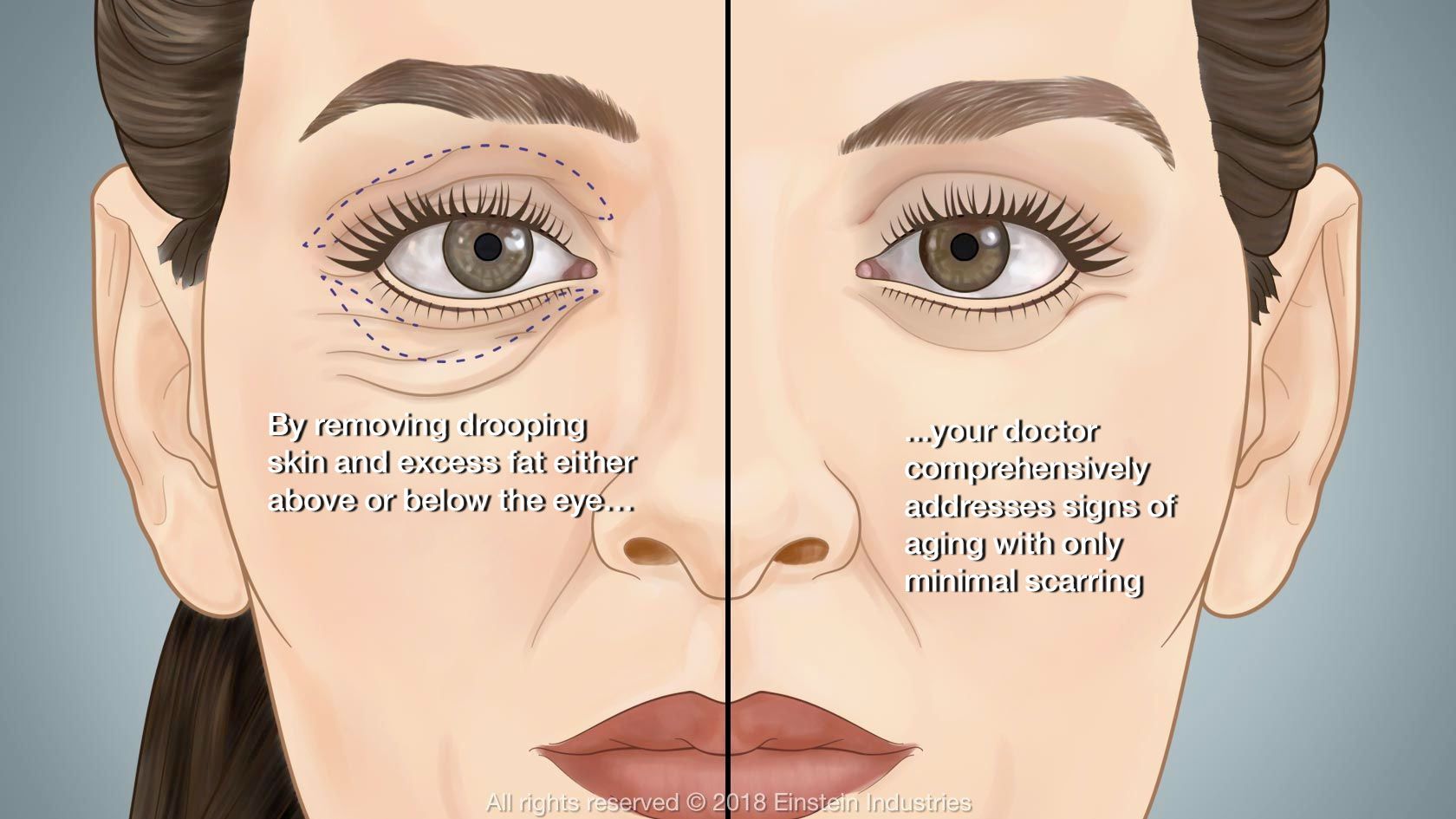 Lower Blepharoplasty Cost Wholesale Outlet Save 55 Jlcatj gob mx Lower Blepharoplasty Cost Wholesale Outlet Save 55 Jlcatj gob mx