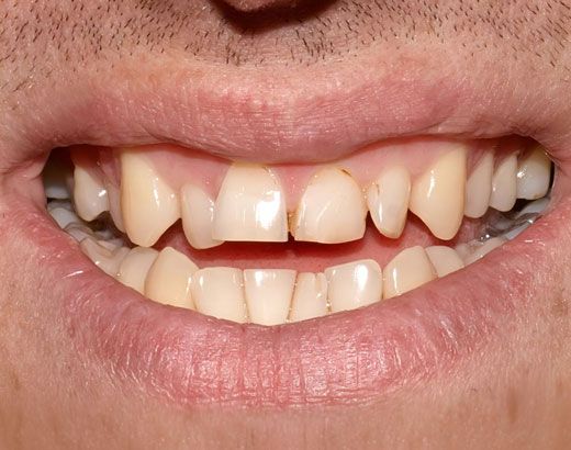 Veneers Troy, MI - Cosmetic Dentistry Institute