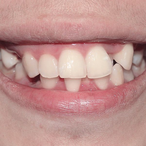 Veneers Nashville, TN - Porcelain Veneers - Iroquois Dentistry