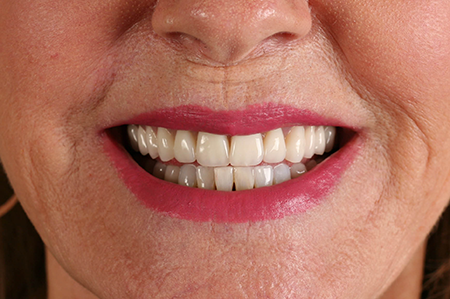 Prosthodontist Altamonte Springs, FL - Orlando, FL - Dentist - Dental Implants Periodontist ...