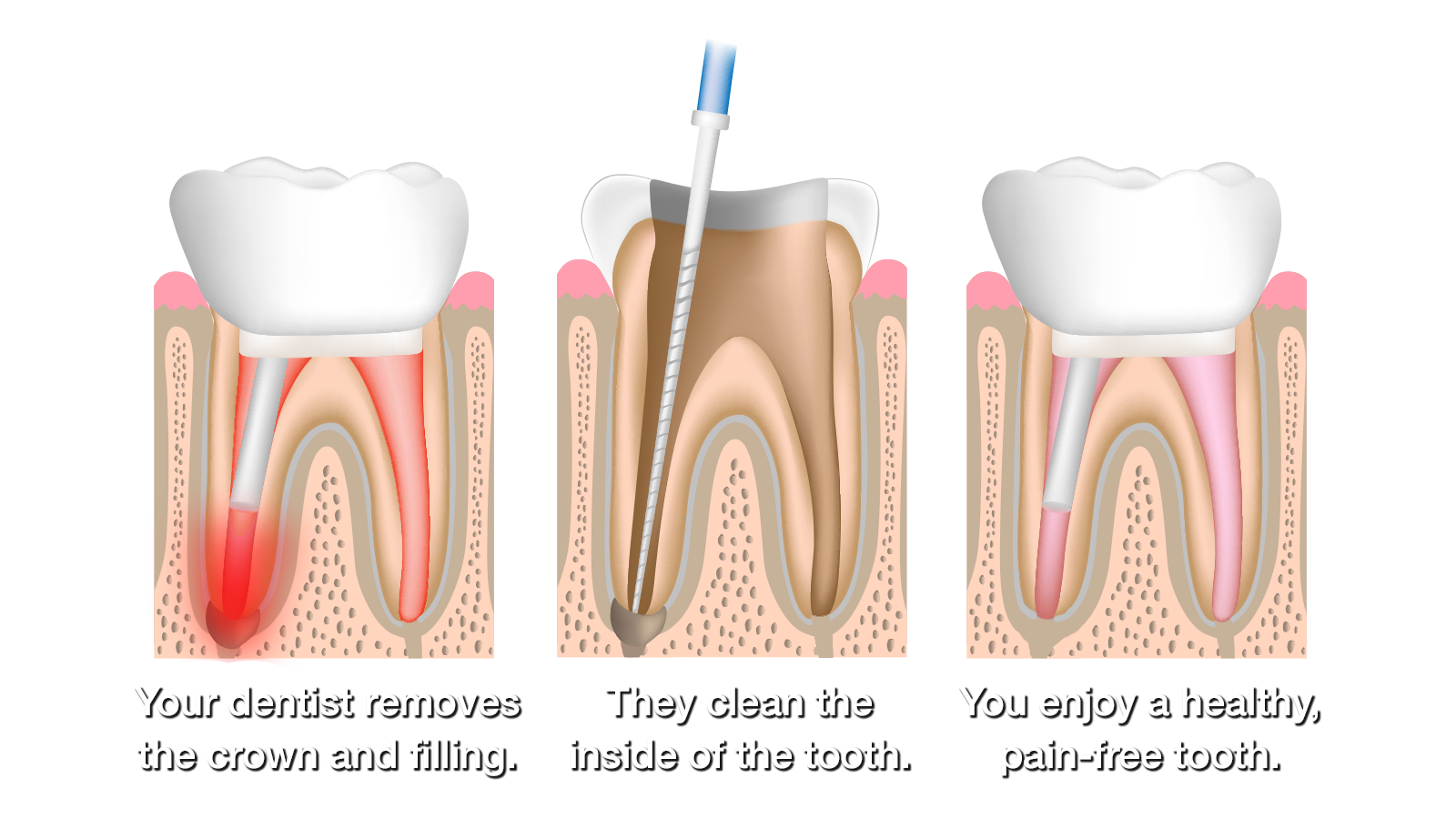 How Long Does A Root Canal Take Nashville TN Gulch Dental Studio
