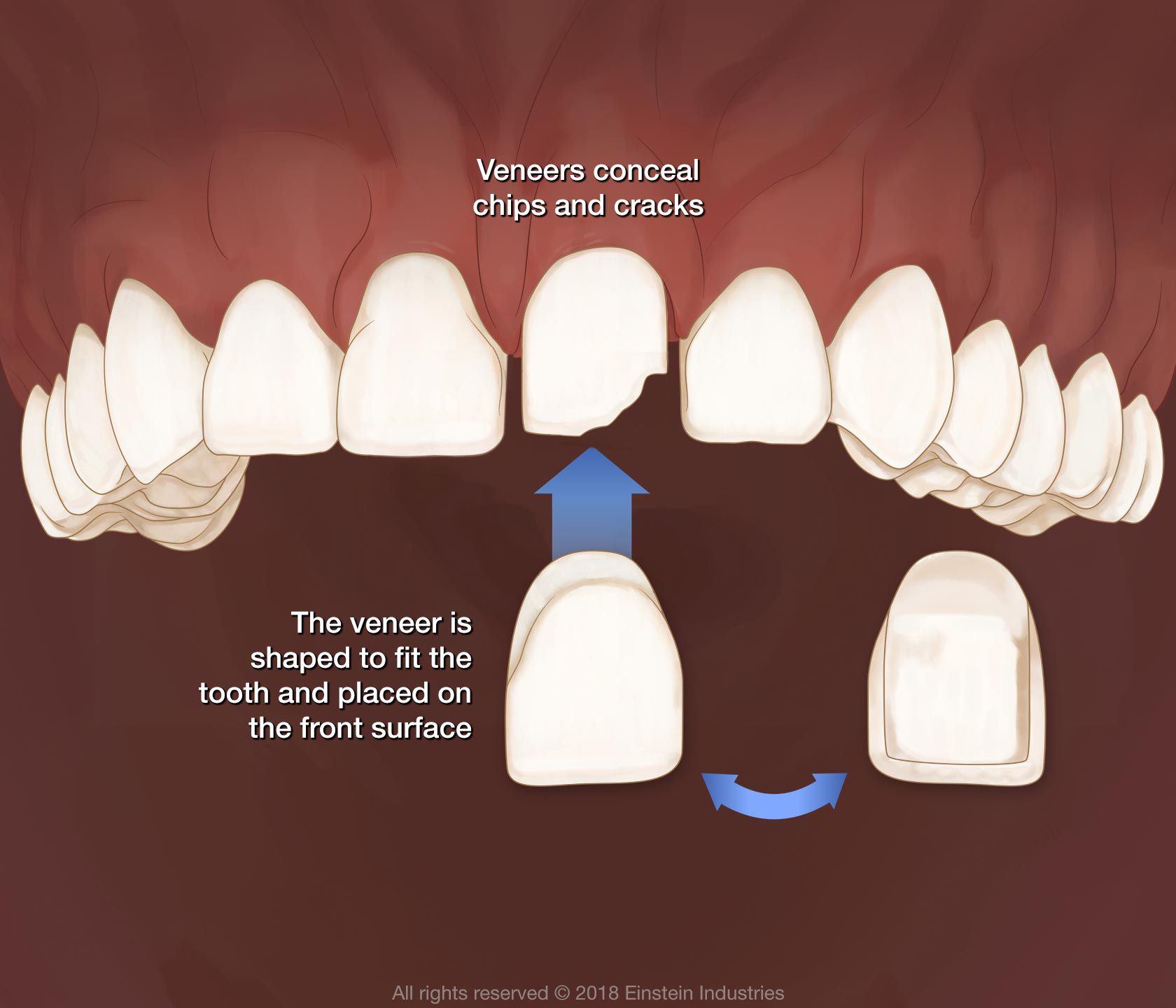 Veneers Brooklyn Heights Brooklyn Fort Greene Porcelain Veneers Veneers Brooklyn Heights Brooklyn Fort Greene Porcelain Veneers