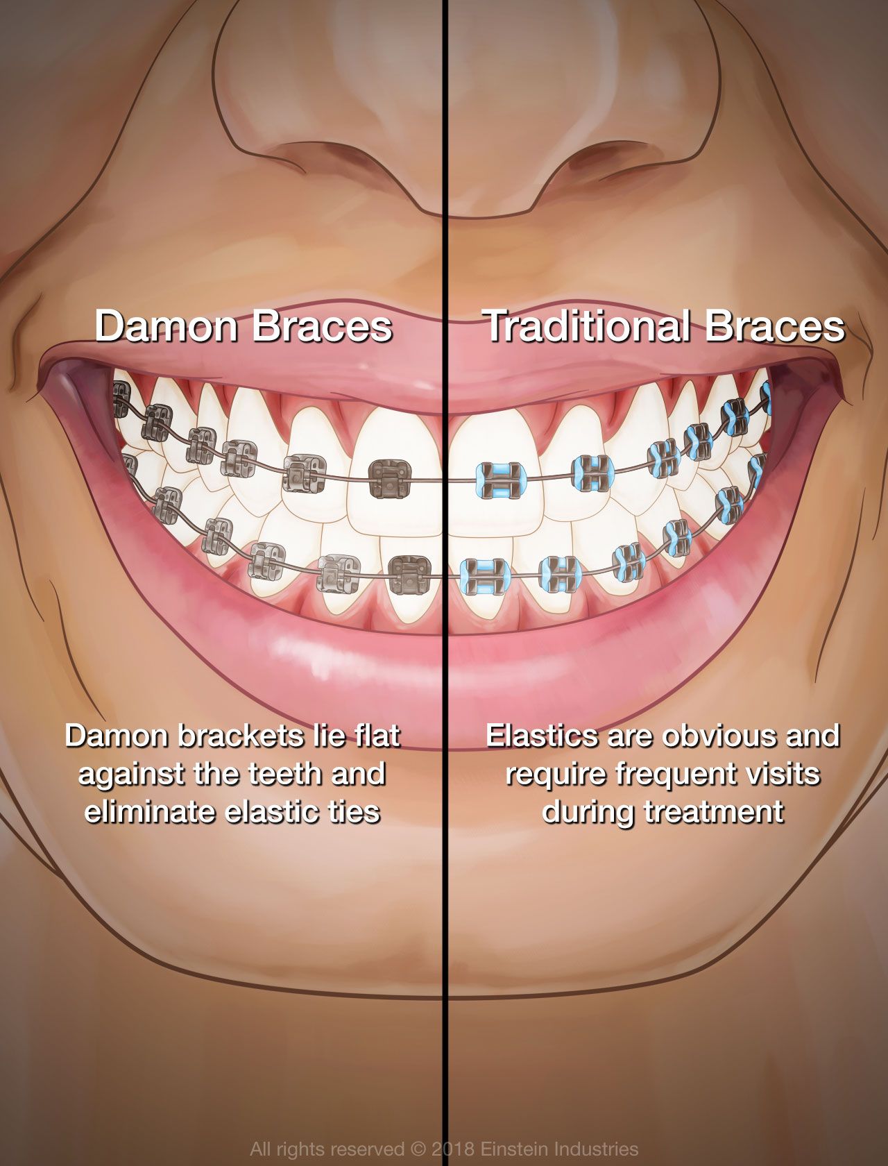 Damon Braces Damon Braces