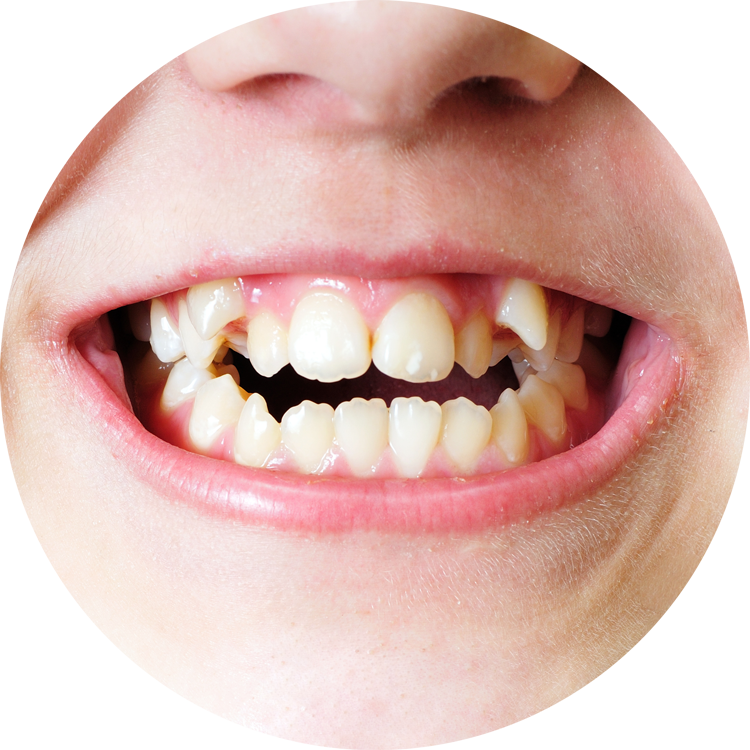 Impacted Canines Impacted Canines