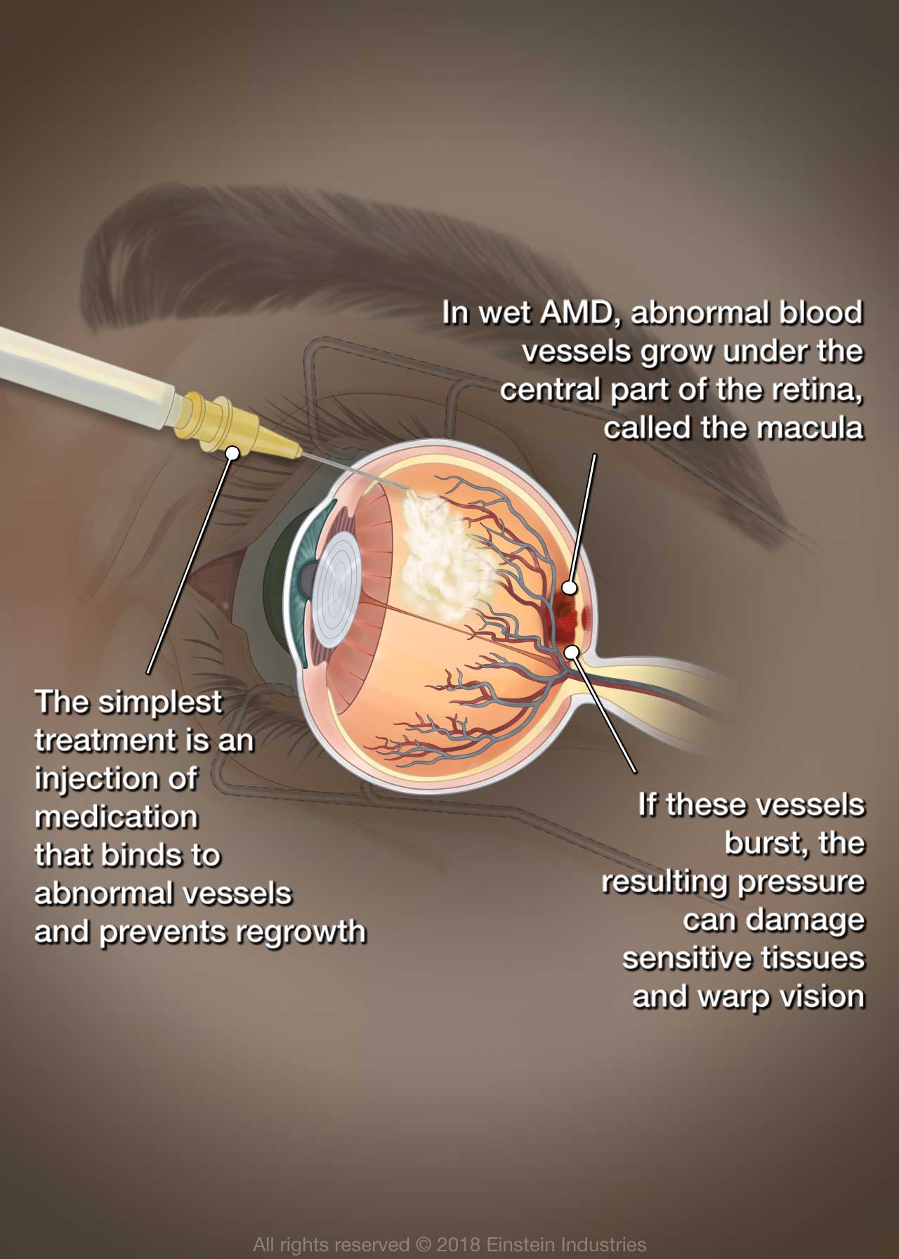 Macular Degeneration Macular Degeneration