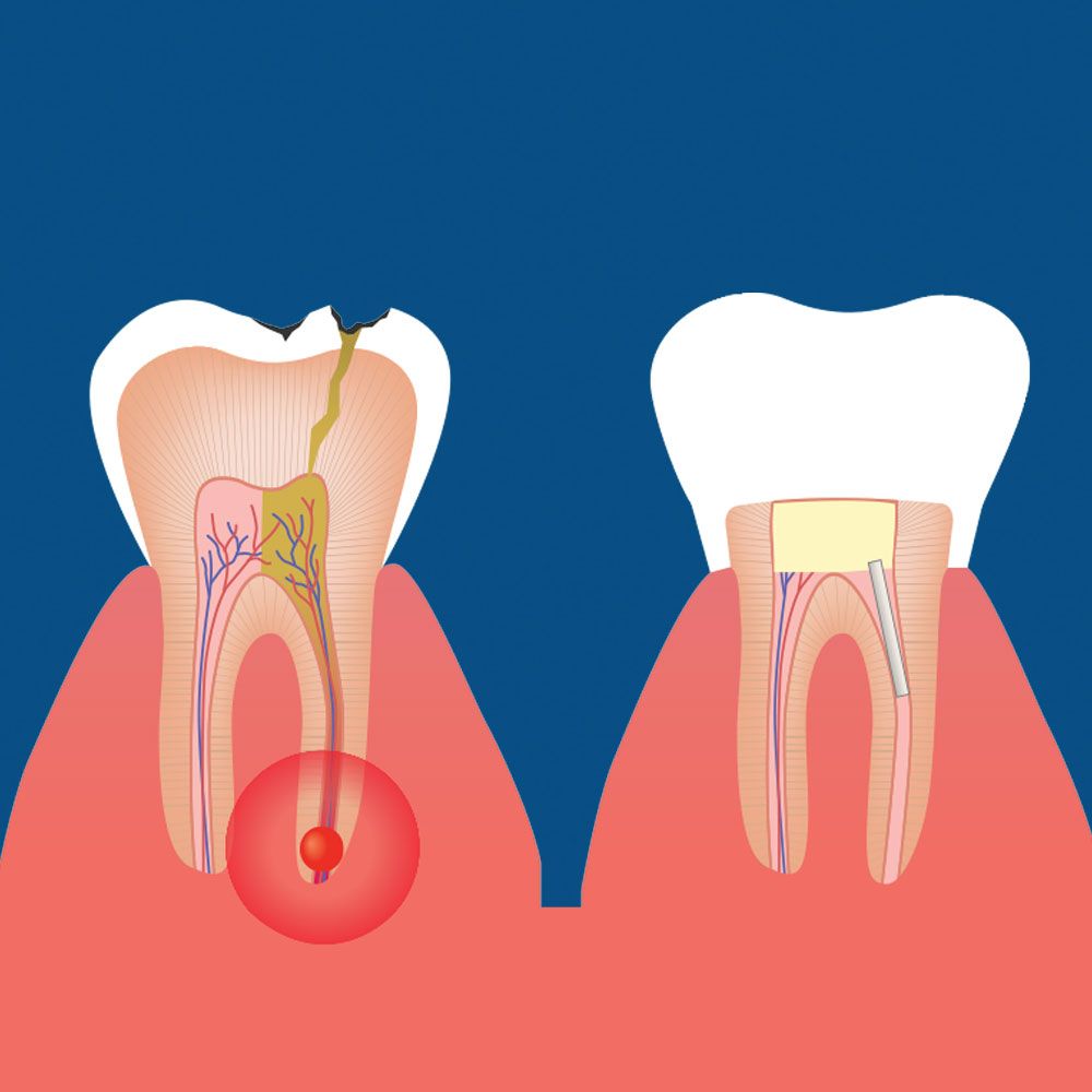 Root Canal Therapy Lakewood CO Bear Creek Family Dental Root Canal Therapy Lakewood CO Bear Creek Family Dental