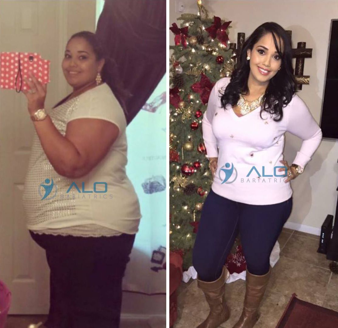 Weight Loss Surgery Tijuana Mexico Bariatric Surgery Alo Bariatrics
